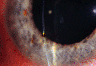 Corneal Rust Ring